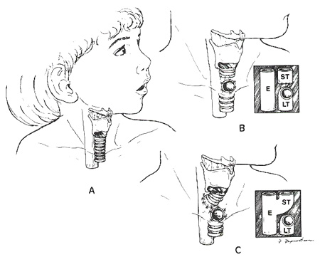 diversion – Aaron's Tracheostomy Page